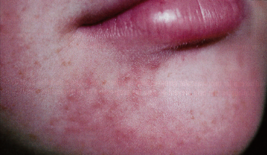 6 Year Old Girl With Bumpy Rash On Chin The Doctor s Channel 6 Year Old Girl With Bumpy Rash On Chin The Doctor s Channel