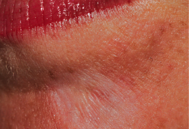 40 Year Old Female With Asymptomatic Rash On Chin The Doctor s 40-year-old-female-with-asymptomatic-rash-on-chin-the-doctor-s