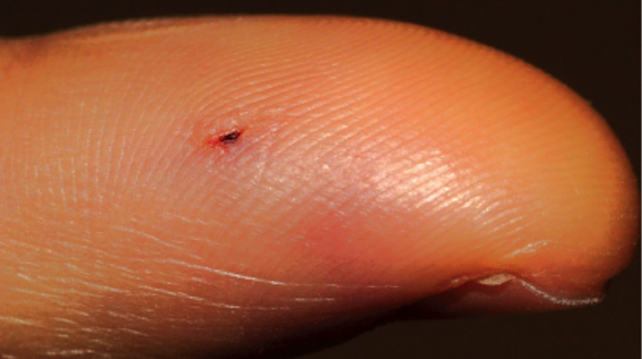 26-Year-Old Female with Rat Bite on Finger - The Doctor's Channel