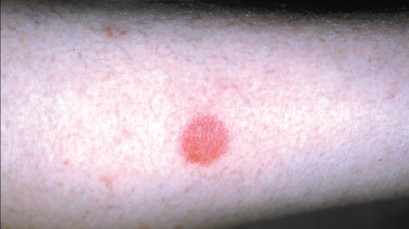 Red Spots On Forearm red-spots-on-forearm
