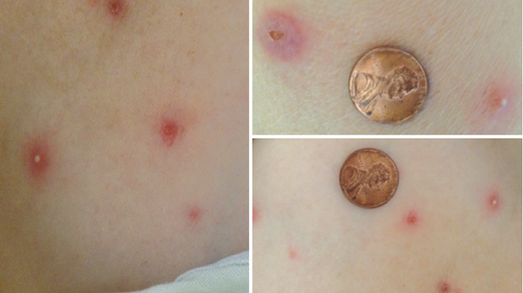 45-Year-Old Female with Papular-Pustular Rash on Face and Legs - The ...