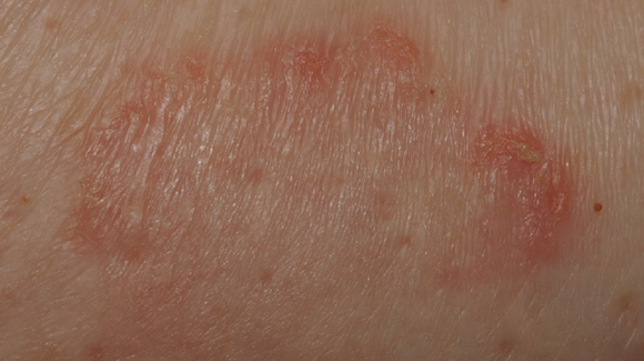 62 Year Old Female With Itchy Rash On Trunk The Doctor s Channel 62-year-old-female-with-itchy-rash-on-trunk-the-doctor-s-channel