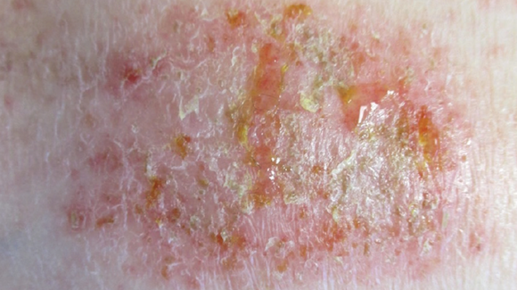 25-Year-Old Male with Pruritic Lesions on Shins - The Doctor's Channel