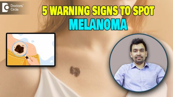 5 Warning Signs of Melanoma | Melanoma & Skin Cancer Awareness Month ...
