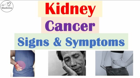 Kidney Cancer (Renal Cell Carcinoma) Signs and Symptoms & Why They ...