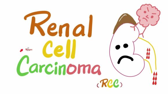 Renal Cell Carcinoma (RCC) – Kidney Tumors – Neoplasms – Renal ...